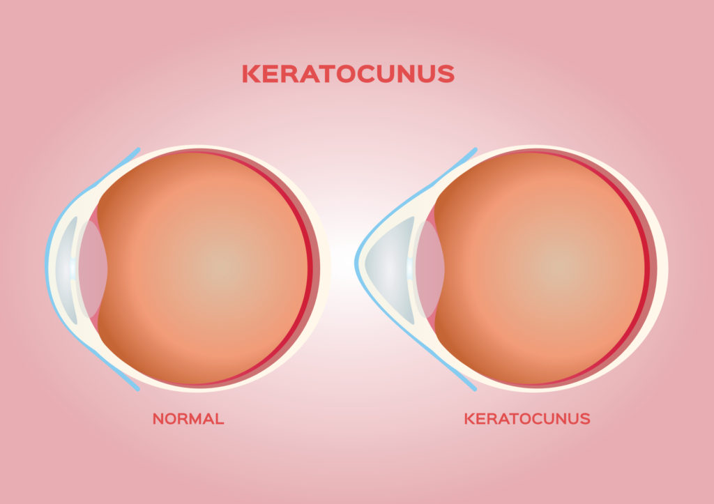 Keratoconus Treatment Options First Eye Care Dfw Optometry
